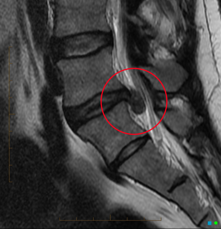 MRT der Lendenwirbelsäule - Vorsorge-Prävention